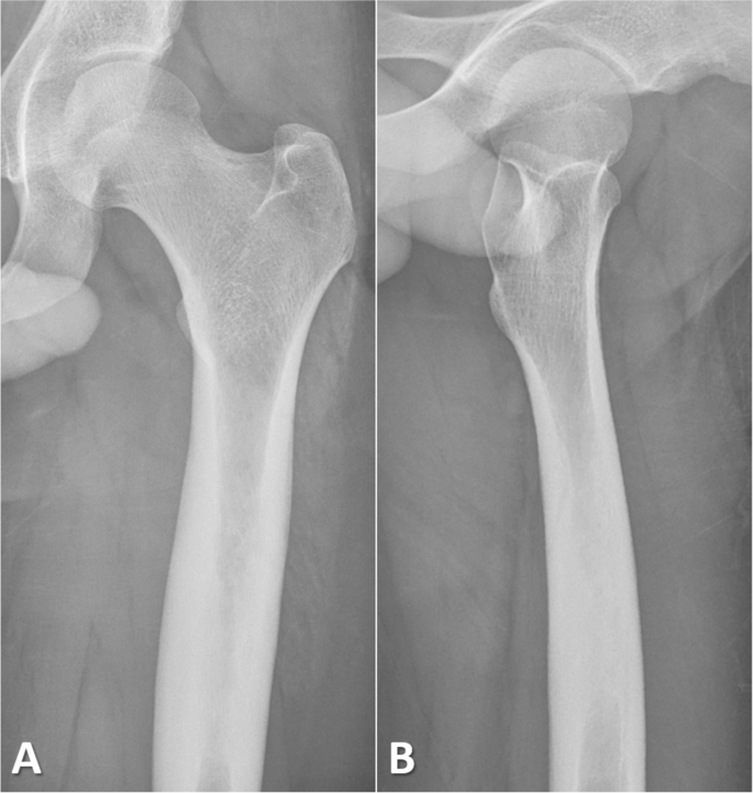 Ribbing disease of the femur: a rare entity | Skeletal Radiology