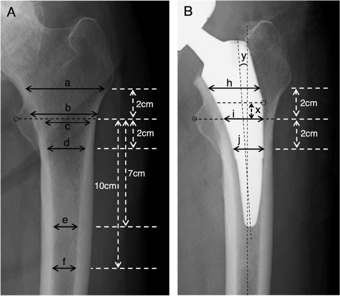 Callus formation after total hip arthroplasty using a short tapered ...