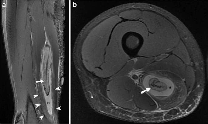 Degloving intramuscular injuries of the semimembranosus and adductor ...