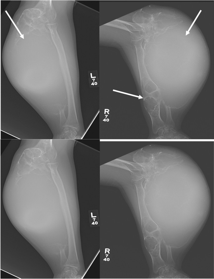 Hemophilic pseudotumor in the bilateral forearms: a unique case report ...