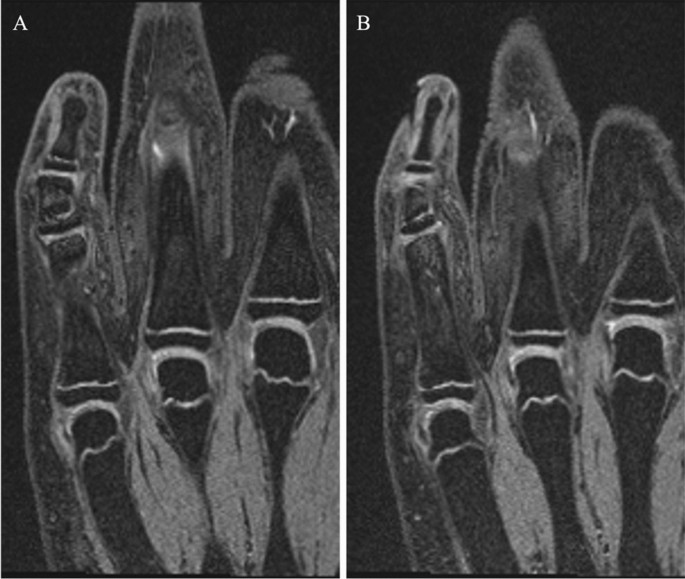 A young girl with a deformed little finger | Skeletal Radiology