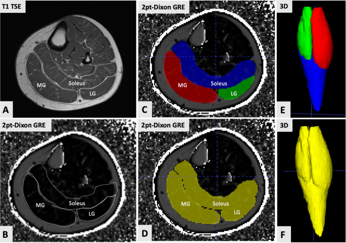 Assessment of calf muscle constitution in chronic Achilles tendon ...