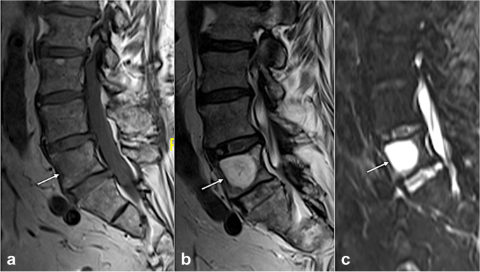 Test yourself answer: an elderly man presenting with features of cauda ...