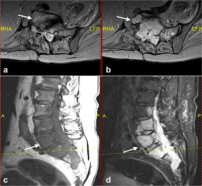 Test yourself answer: an elderly man presenting with features of cauda ...