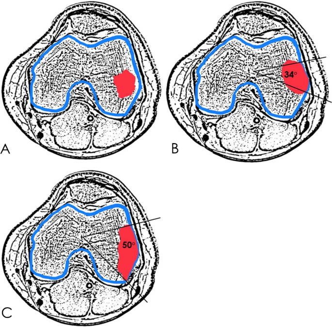Retrospective validation of the Birmingham atypical cartilage tumor ...