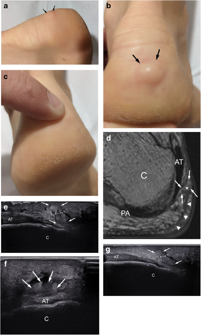 Ultrasound and magnetic resonance imaging (MRI) assessment of ...