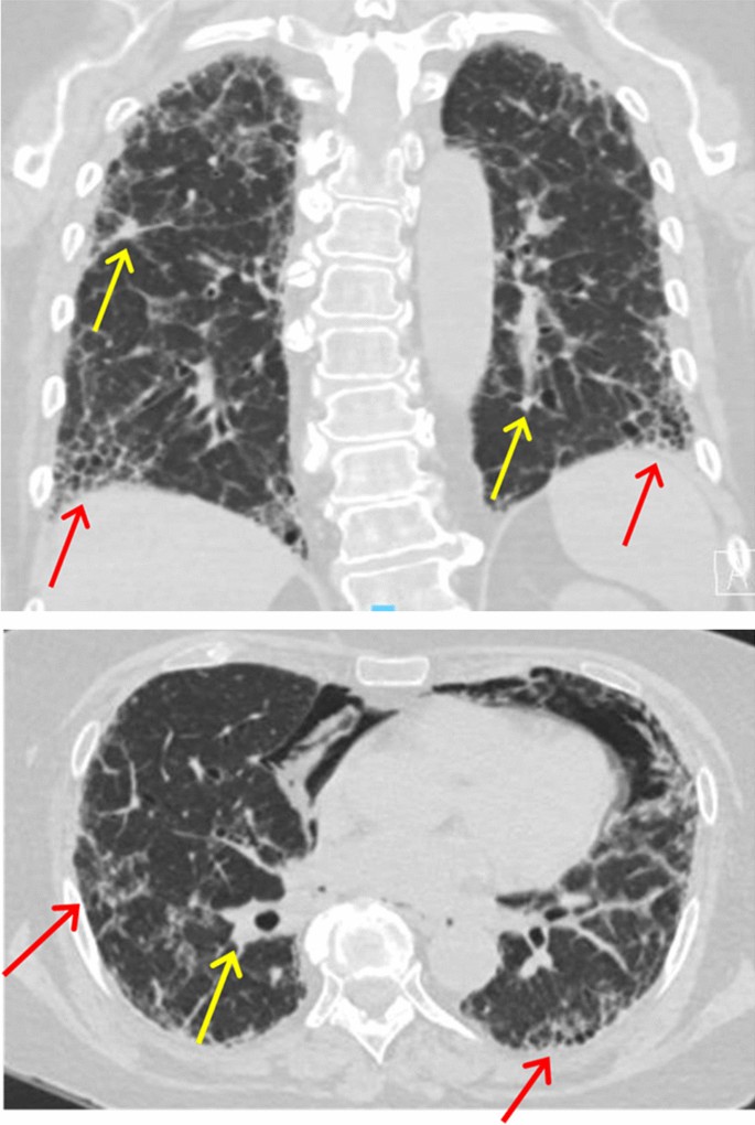 Review of pulmonary manifestations of rheumatoid arthritis | Skeletal ...