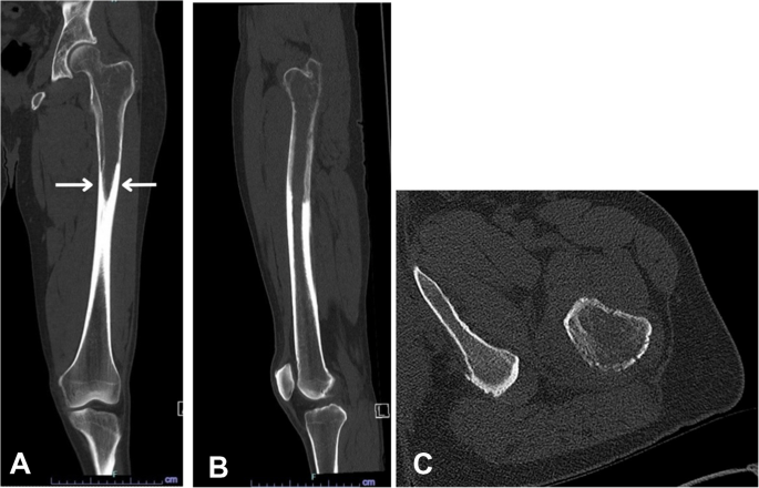 Lymphoma masquerading as Paget’s disease of bone: a rare diagnostic ...