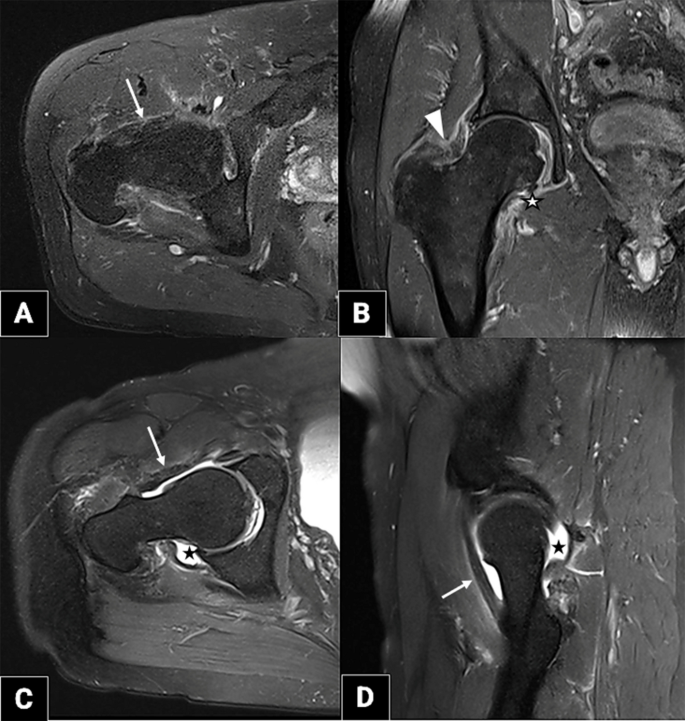 Hip capsular thickness as a marker for inflammatory conditions ...
