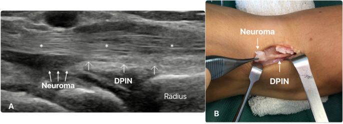 Ultrasound exploration of distal posterior interosseous nerve post ...
