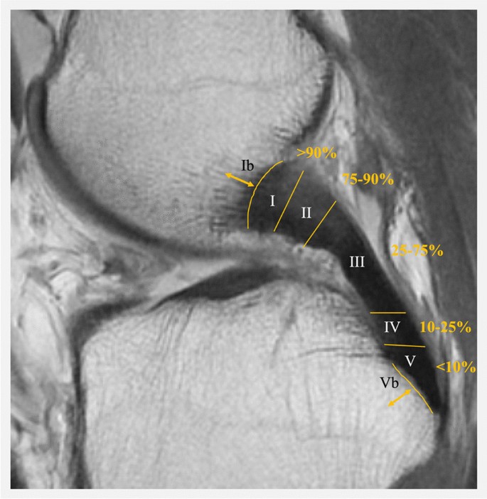 Tear location of posterior cruciate ligament tears: introduction and ...