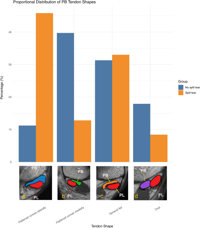 Association between flat variants of the peroneus brevis tendon and ...