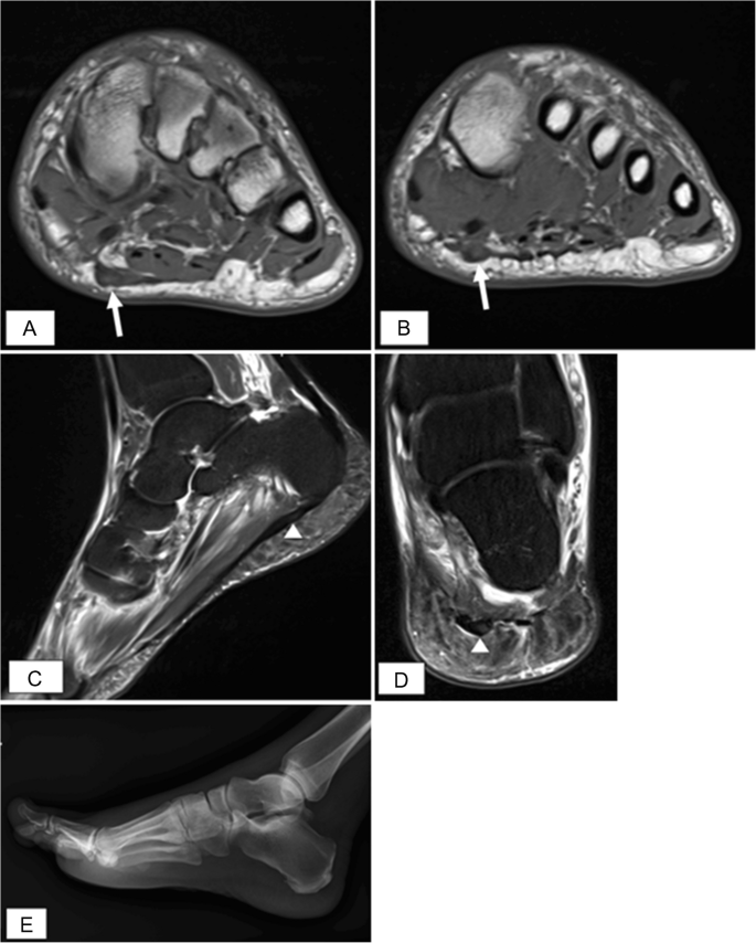 MRI characteristics of plantar fibromas: a large consecutive series ...