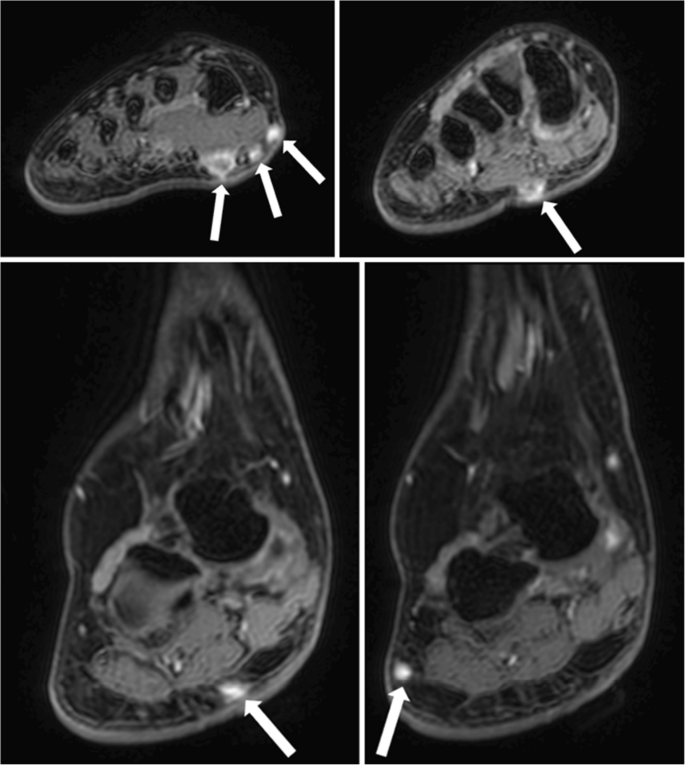 MRI characteristics of plantar fibromas: a large consecutive series ...