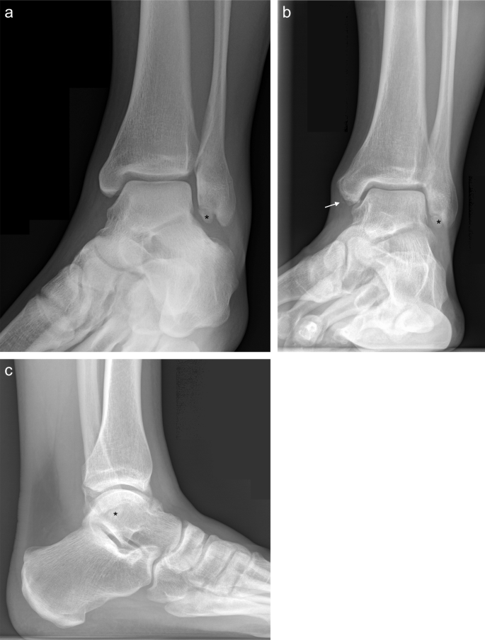 Unstable os subfibulare in the setting of tibiotalar instability ...