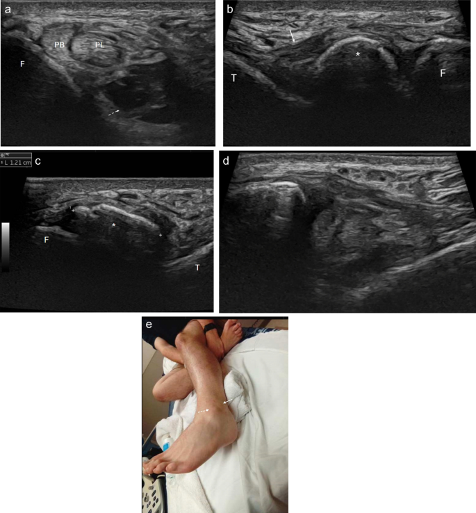 Unstable os subfibulare in the setting of tibiotalar instability ...