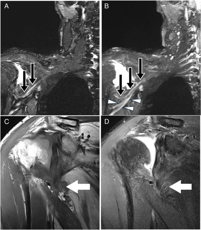 Magnetic resonance imaging features of axillary nerve injuries ...
