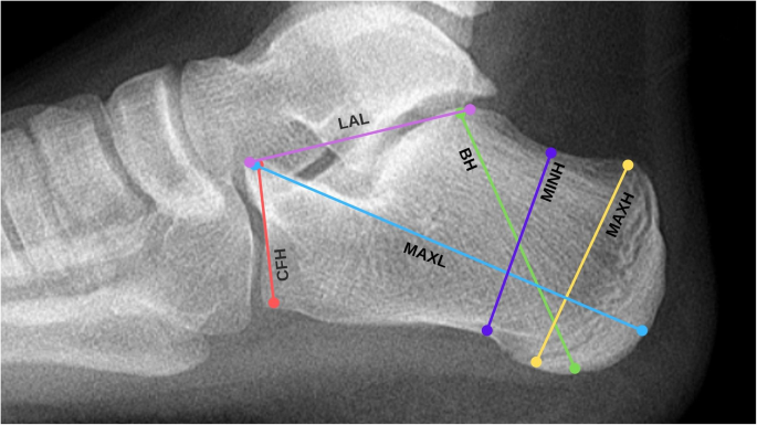 Linear radiographic measurements of the calcaneus in pediatric ...