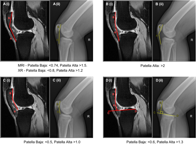 Radiological assessment of patellar instability: comparative analysis ...