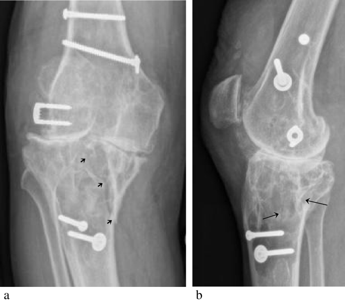 Late-onset osteolysis and pathologic tibial plateau fracture following ...