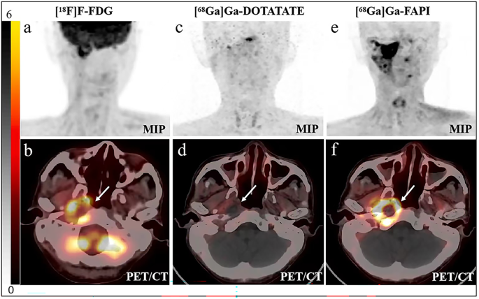 A head-to-head comparison of [68Ga]Ga-DOTATATE and [68Ga]Ga-FAPI PET/CT in patients with ...