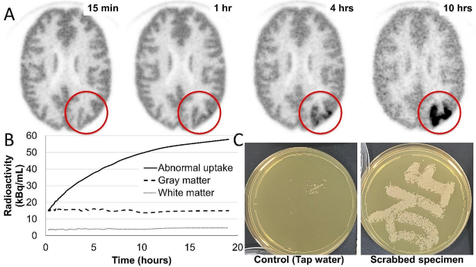 Abnormal localized [18F]FDG accumulation in a Hoffman 3D brain phantom ...