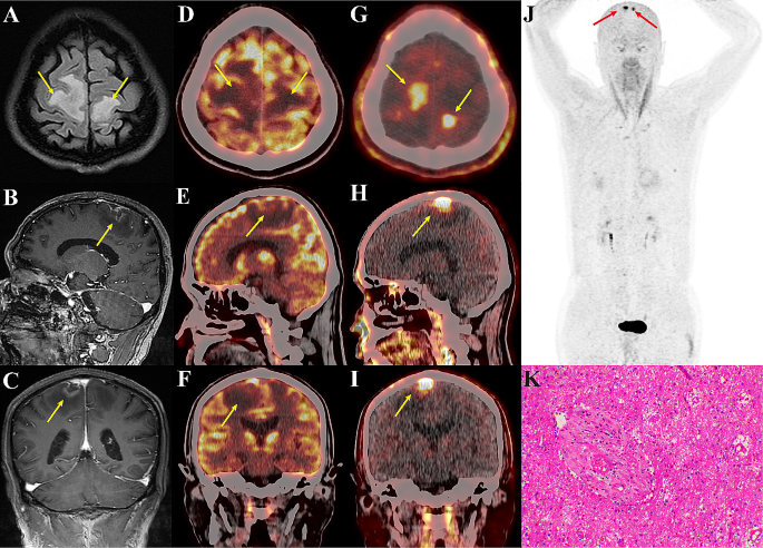 [68Ga]Ga-FAPI-04 PET/CT imaging of a patient with neurosyphilis ...
