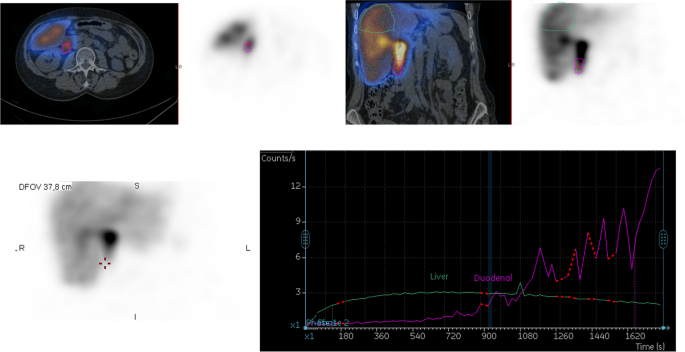 Hepatobiliary scintigraphy in post-cholecystectomy patients: added ...