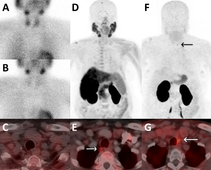 68Ga-Trivehexin PET/CT: a promising novel tracer for primary ...