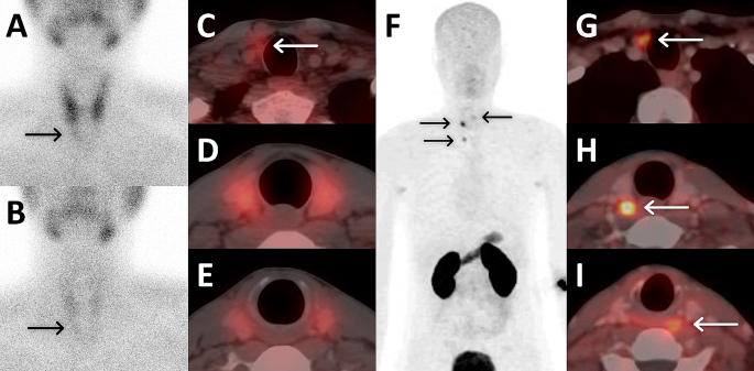 68Ga-Trivehexin PET/CT: a promising novel tracer for primary ...