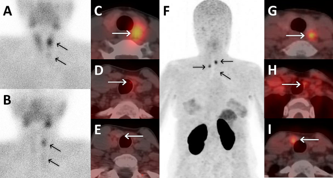 68Ga-Trivehexin PET/CT: a promising novel tracer for primary ...