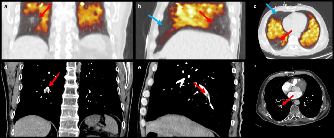 Pulmonary embolism as an incidental finding in [15O]H2O PET/CT ...