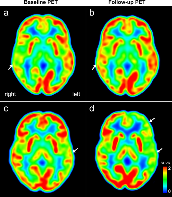 [18F]FDG PET for mapping the cerebral glucose metabolic characteristics ...