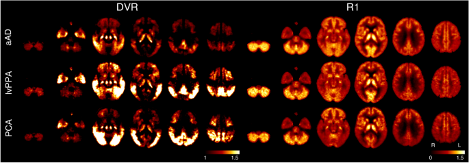 Multi-parametric [18F]PI-2620 tau PET/MRI for the phenotyping of ...