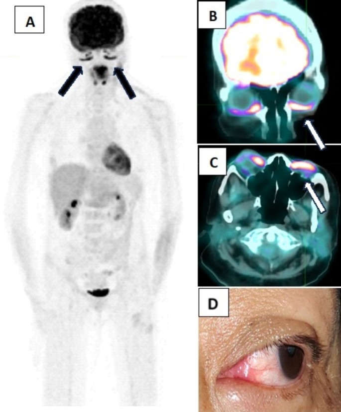 The eye-black sign of lower eyelids related to R-CHOP therapy: a rare ...