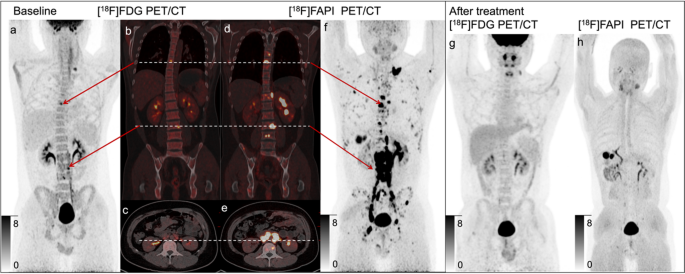 Atypical [18F]FDG avidity in ALK-positive anaplastic large cell ...