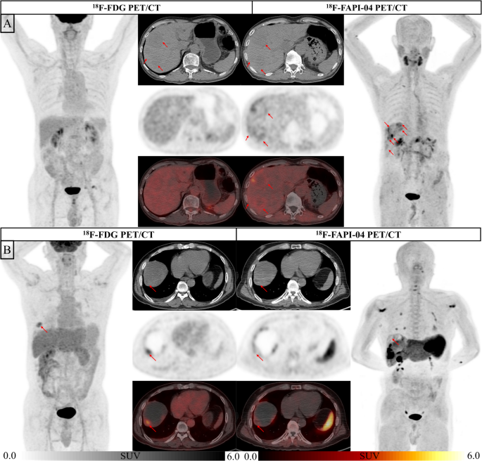 The diagnostic value of 18 F-FAPI-04 PET/CT in unresectable ...