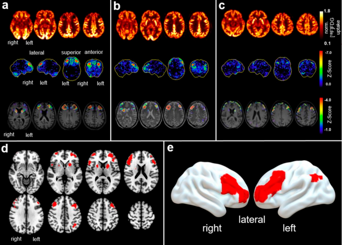 [18F]FDG-PET reveals early postoperative cortical dysfunction after ...