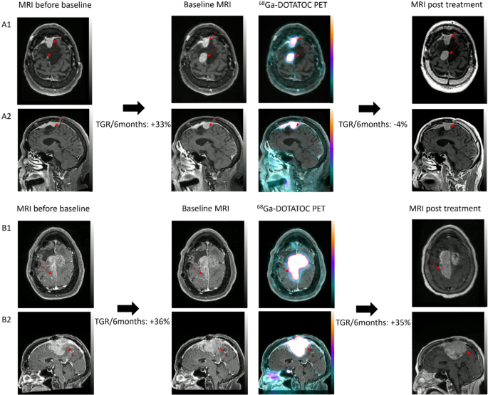 [177Lu]Lu-DOTATATE for refractory meningiomas: factors associated with ...