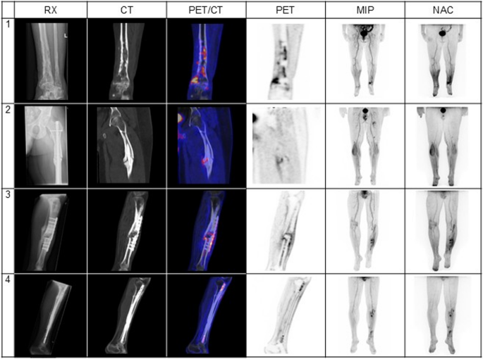 Clinical evaluation of dynamic [18F]FDG PET imaging to distinguish ...