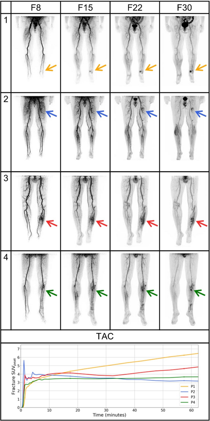 Clinical evaluation of dynamic [18F]FDG PET imaging to distinguish ...