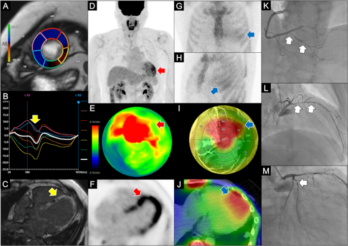 Extensive LGE and FDG/PYP uptake mimicking infiltrative disease: A case ...