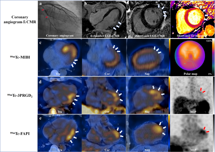 Mapping Post-AMI ventricular remodeling with Dual-Tracer 99mTc-3PRGD2 ...