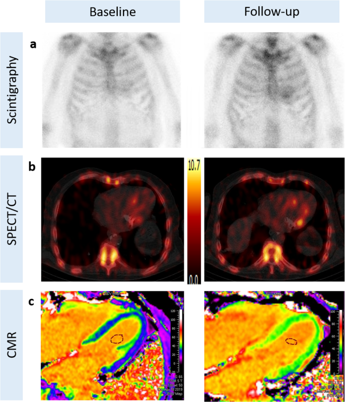 Additive diagnostic value of thoracic SPECT/CT imaging in perugini ...