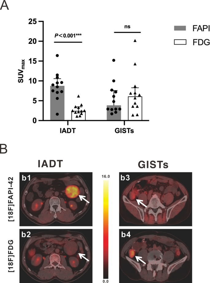 Differential [18F]FAPI-42 and [18F]FDG uptake patterns distinguish ...