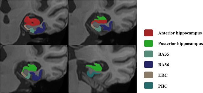Spatiotemporal dynamics of tau pathology and neurodegeneration in ...