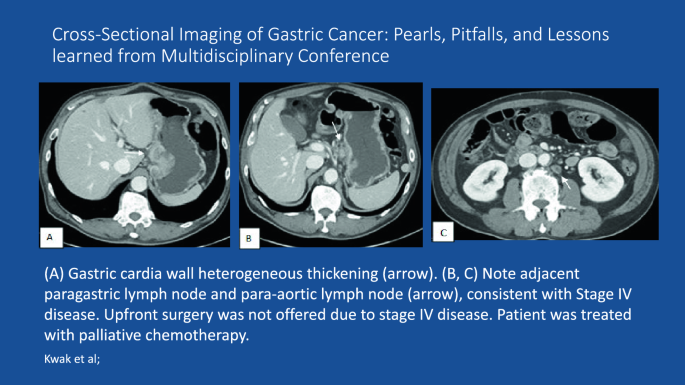 Cross-sectional imaging of gastric cancer: pearls, pitfalls and lessons ...