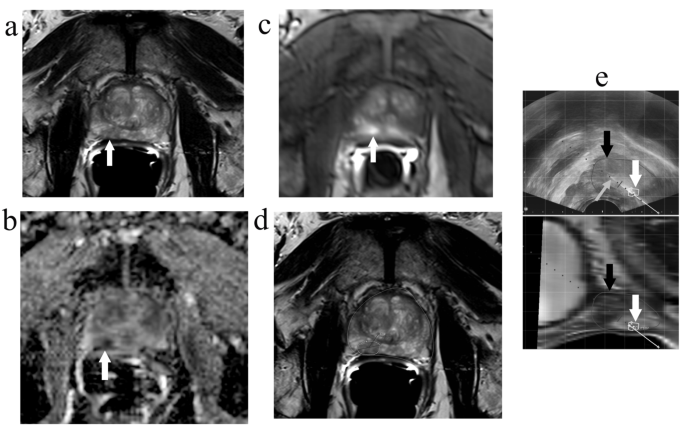 Targeted biopsy of the prostate | Abdominal Radiology