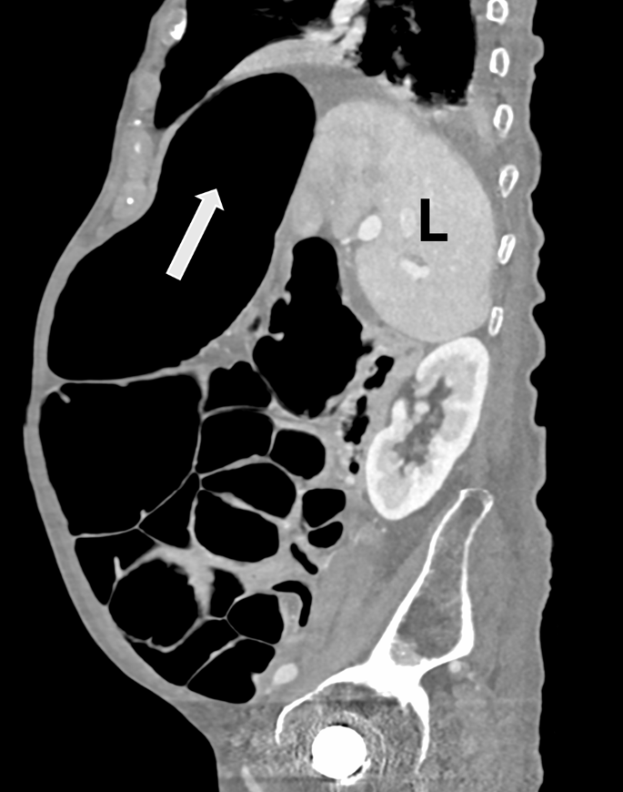 The liver overlap sign | Abdominal Radiology