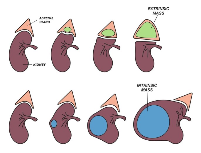 The “claw” sign | Abdominal Radiology